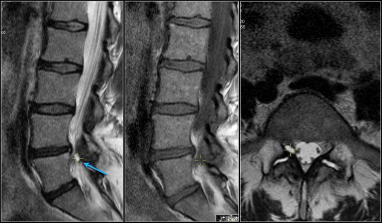The Radiology Assistant : Lumbar Disc Herniation