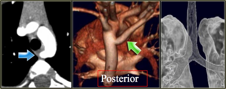 The Radiology Assistant : Vascular Anomalies of Aorta, Pulmonary and ...
