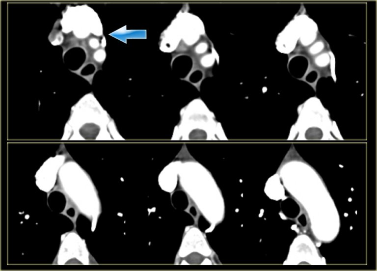 The Radiology Assistant : Vascular Anomalies of Aorta, Pulmonary and ...
